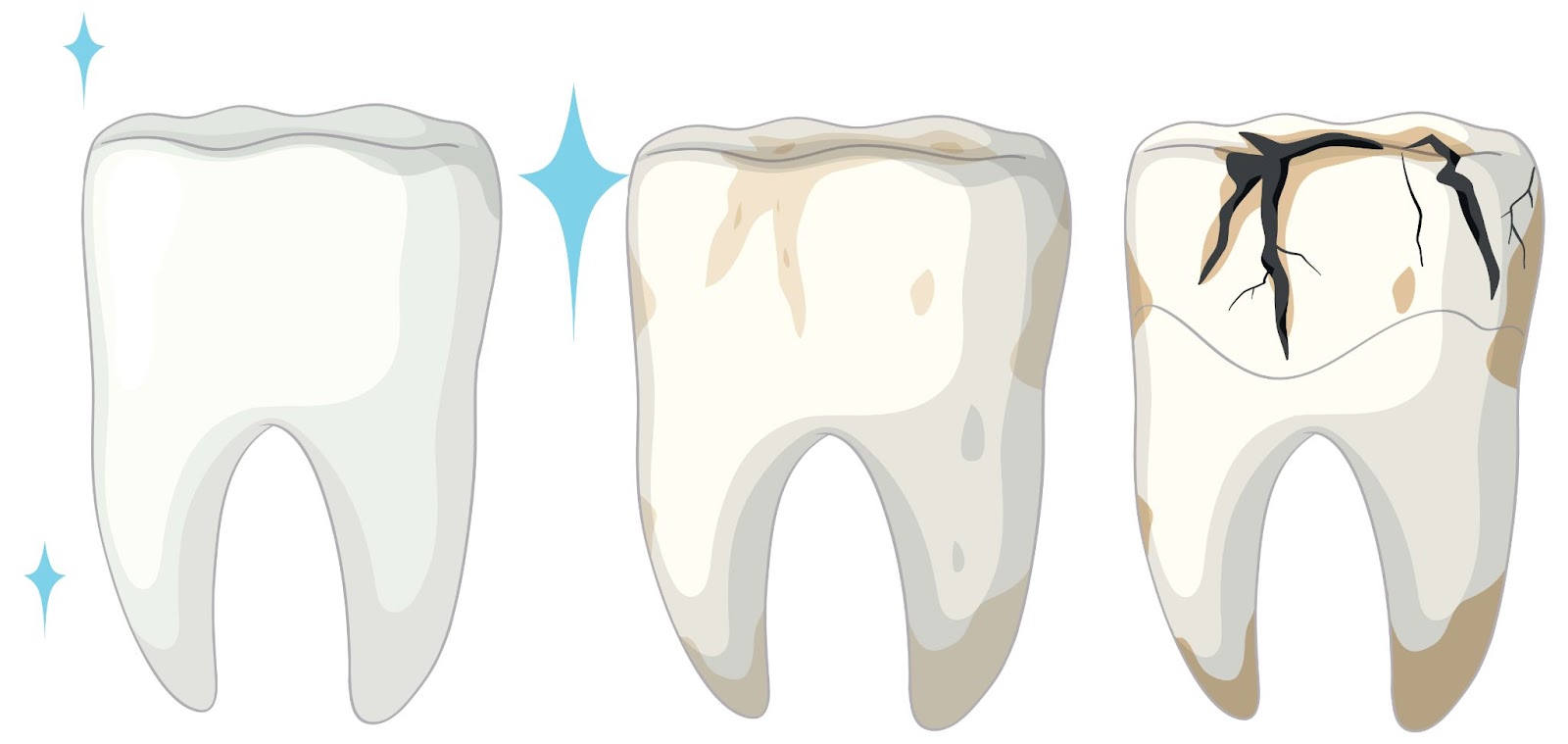 What Does A Cavity Feel Like? | Dental Artistry